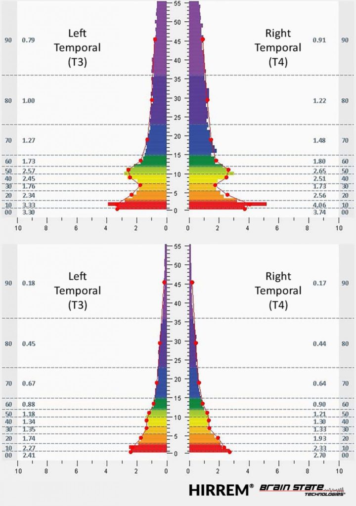Brain State Technologies: Successful clinical trial shows reduction of ...